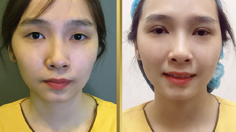 Sự khác biệt giữa cắt mí Mini Deep và Full Deep là gì? - Cắt Mắt Hai Mí