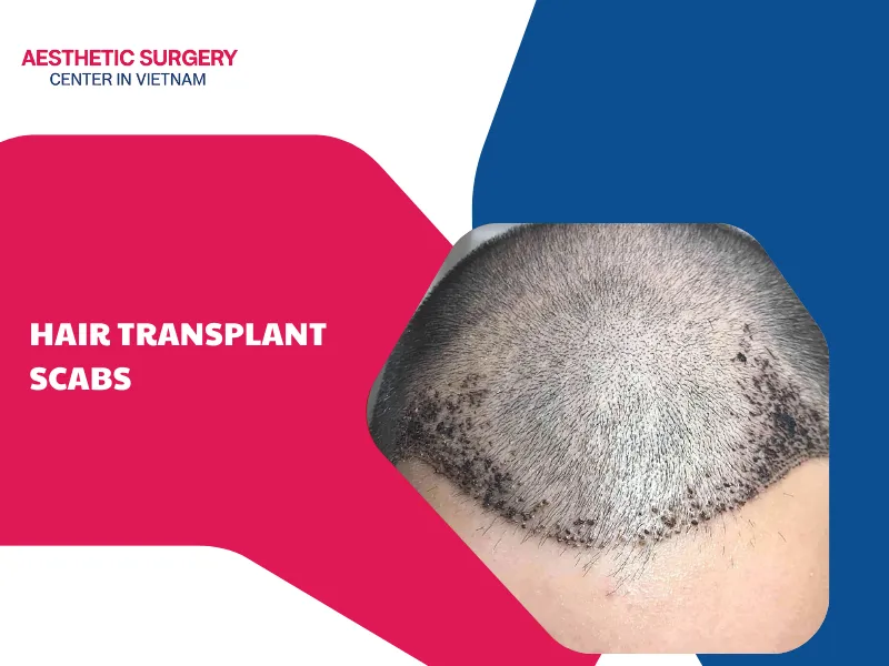 What are hair transplant scabs? How to manage them safely