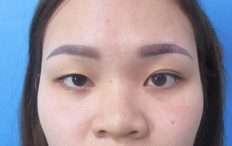 Mắt bồ câu con đậu con bay là gì? Khắc phục như thế nào?