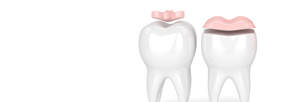 Hàn răng sứ Onlay Emax - Những ưu điểm và hạn chế