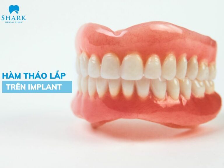 Hàm tháo lắp trên implant là gì? Loại nào tốt nhất?