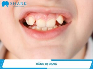 Các phương pháp khắc phục tình trạng răng dị dạng hiệu quả