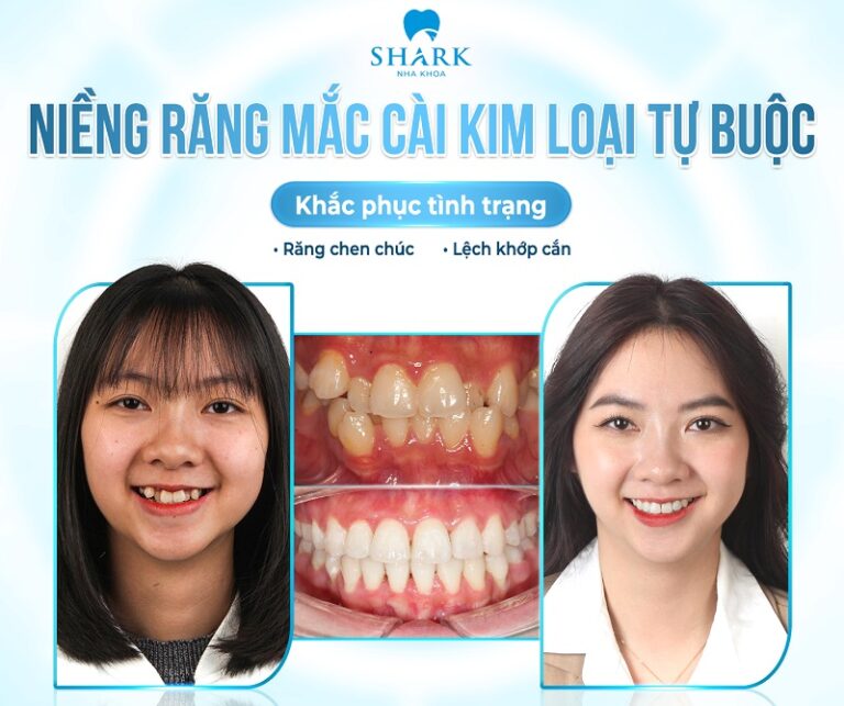 Chiêm ngưỡng những hình ảnh niềng răng đẹp trước và sau