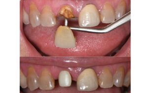 Cắm chốt răng - Giải pháp tối ưu để bảo tồn răng thật