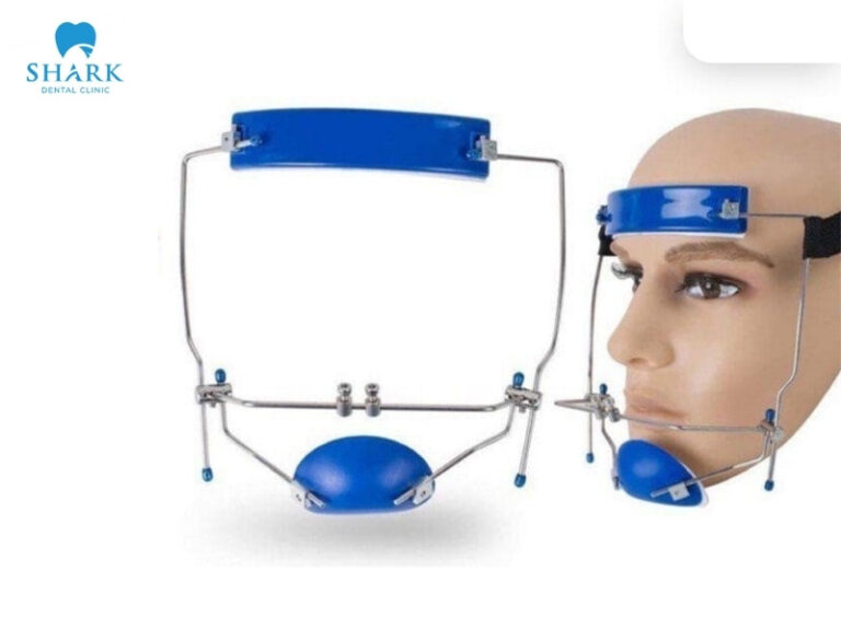 Facemask chỉnh nha là gì? Có nên đeo Facemask không?