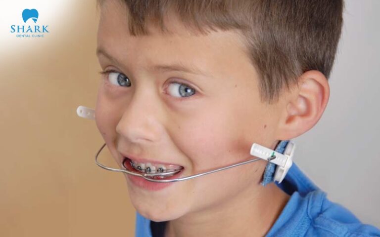 Headgear chỉnh nha là gì? Cấu tạo và tác dụng như thế nào?