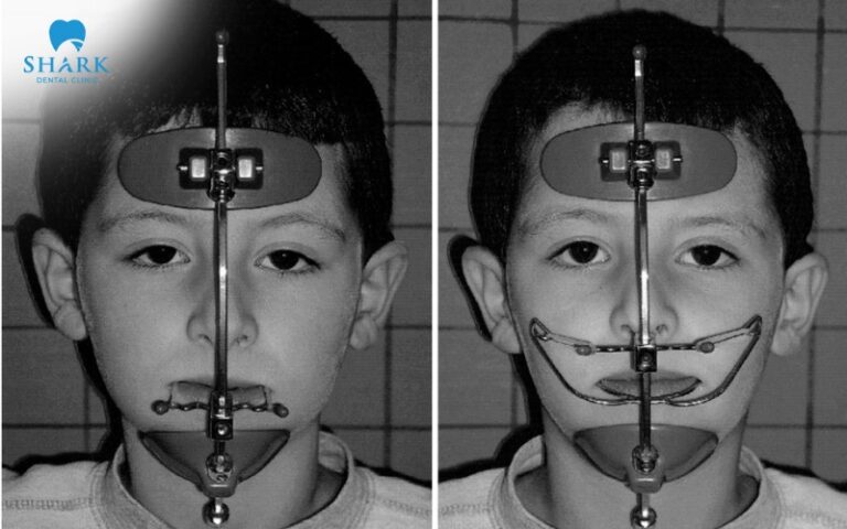 Headgear chỉnh nha là gì? Cấu tạo và tác dụng như thế nào?