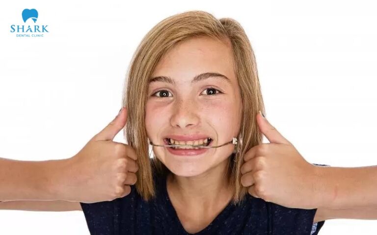 Headgear chỉnh nha là gì? Cấu tạo và tác dụng như thế nào?