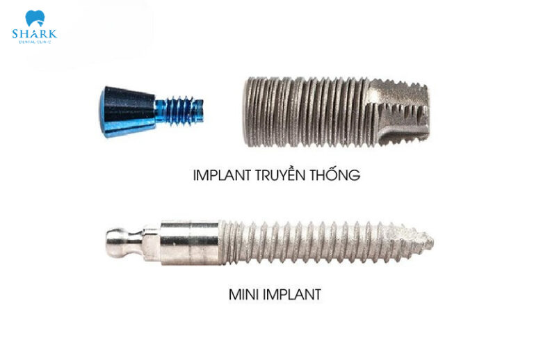 Mini Implant là gì? Có khác gì với Implant truyền thống?