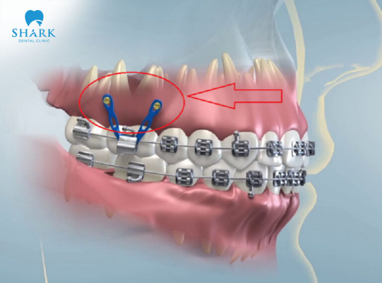 Loop đóng khoảng răng cửa và những thông tin quan trọng