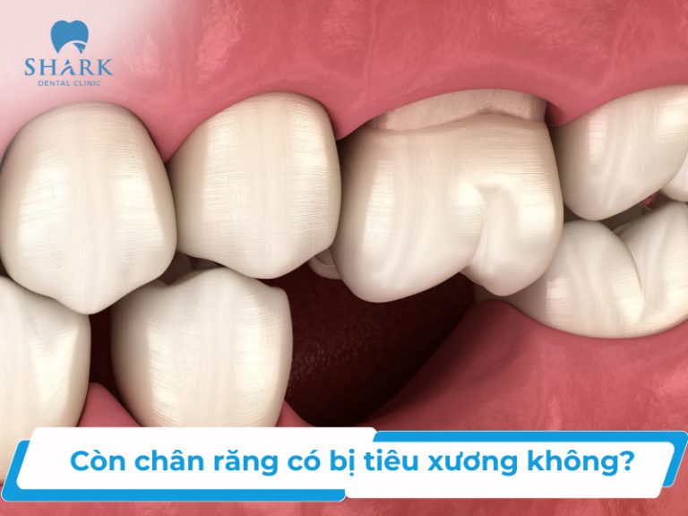Bác sĩ giải đáp: Còn chân răng có bị tiêu xương không?
