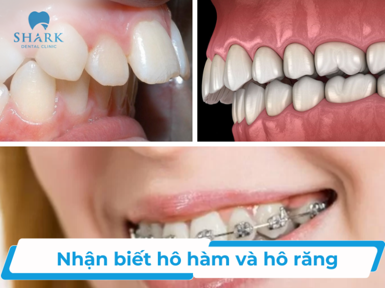 Hướng dẫn cách nhận biết hô hàm và hô răng hiệu quả