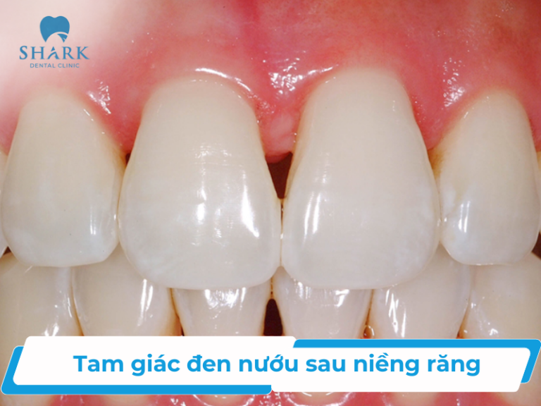 Chi phí niềng răng ở bệnh viện răng hàm mặt mới nhất 2024