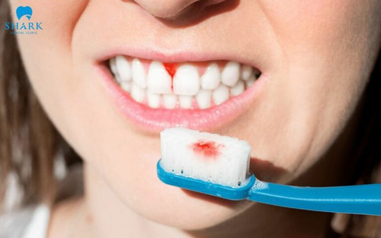 Bọc răng sứ bị viêm lợi có nguy hiểm không, làm sao chữa?