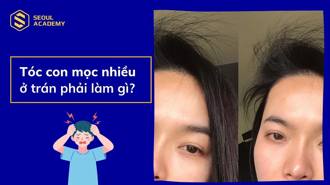 Vì sao tóc con mọc nhiều ở trán? Cách xử lý như thế nào?
