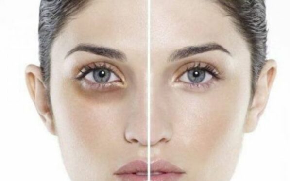 Mắt sâu có ý nghĩa gì? Cách khắc phục đôi mắt sâu kém duyên