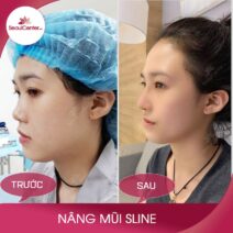 Lỗ mũi hở là gì? Ý nghĩa, tướng số tốt hay xấu ở nam và nữ?