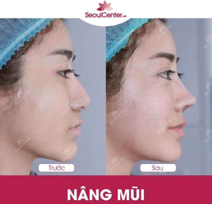 Mũi tam giác là gì? Tướng số như thế nào? Có nên sửa không?