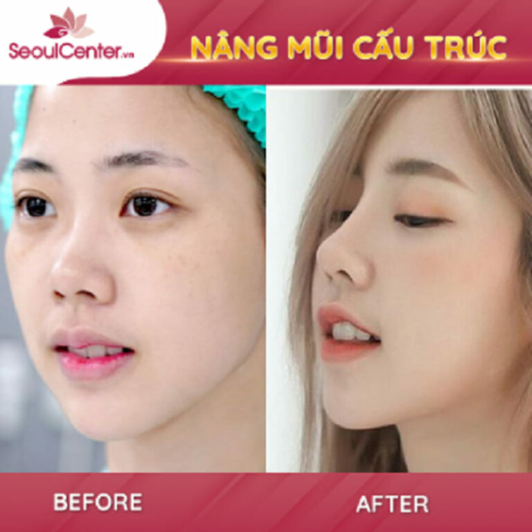 Mũi tam giác là gì? Tướng số như thế nào? Có nên sửa không?