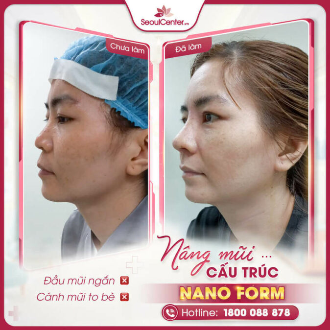 Nâng mũi Nanoform là gì? Sụn Nanoform có tốt không? - Seoul Center