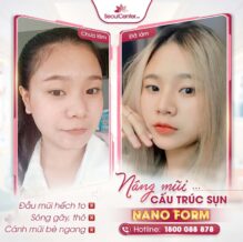 Nâng mũi Nanoform là gì? Sụn Nanoform có tốt không? - Seoul Center