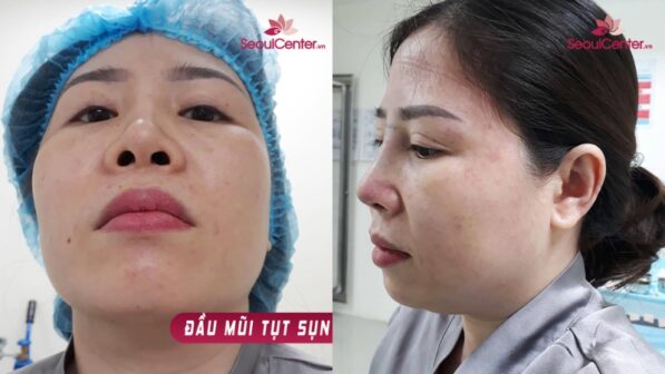 Hình ảnh sau khi tháo sụn mũi, khắc phục biến chứng nâng mũi hỏng