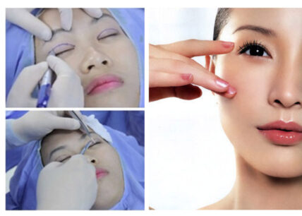 Cắt mí full là gì? So sánh cắt mí mắt full và cắt mí mini