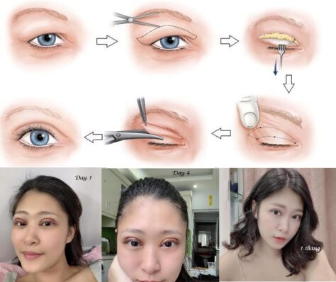 Mắt cụp là gì? Nguyên nhân và cách khắc phục mắt cụp - Seoul Center