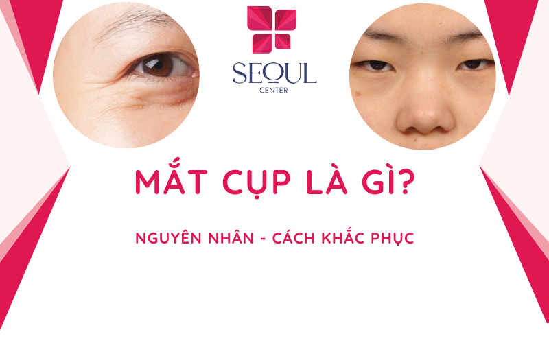 Mắt cụp là gì? Nguyên nhân và cách khắc phục mắt cụp - Seoul Center
