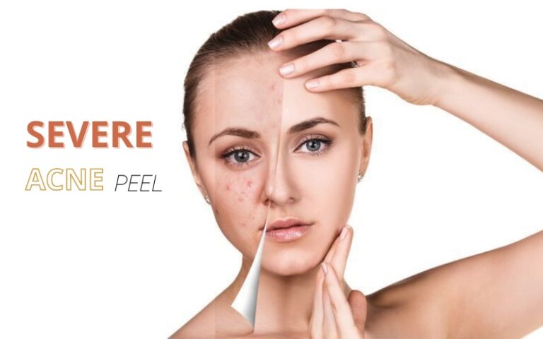 Severe Acne Peel - Công nghệ Peel da trị mụn nặng hot 2023