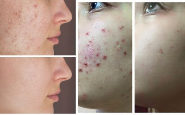 Severe Acne Peel - Công nghệ Peel da trị mụn nặng hot 2023