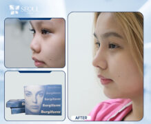 Nâng mũi Surgiform là gì? Ưu điểm của nâng mũi bằng sụn surgiform