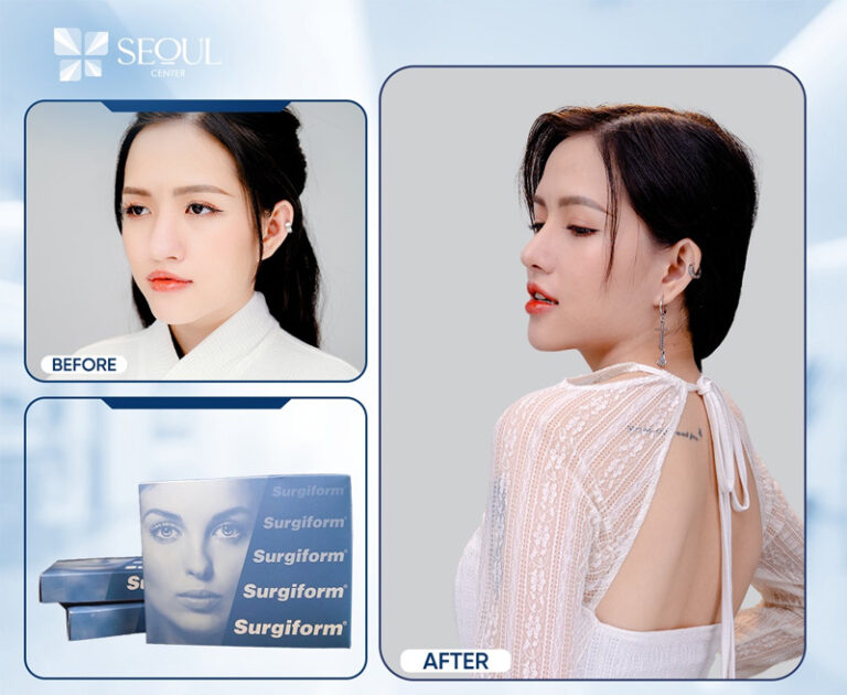 Nâng mũi Surgiform là gì? Ưu điểm của nâng mũi bằng sụn surgiform