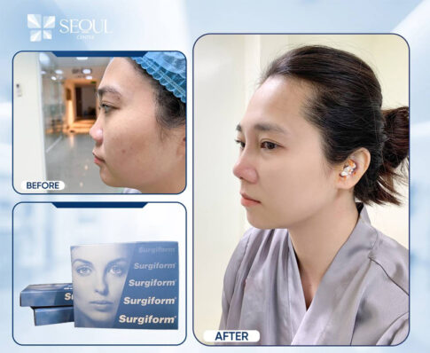 Nâng mũi Surgiform là gì? Ưu điểm của nâng mũi bằng sụn surgiform