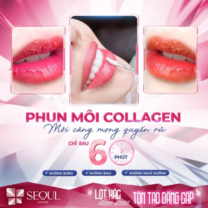 Top 10 công nghệ phun môi mới cho phái đẹp 2026