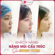 Lỗ mũi hở là gì? Ý nghĩa, tướng số tốt hay xấu ở nam và nữ?