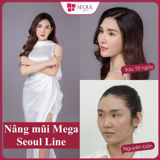 Lỗ mũi hở là gì? Ý nghĩa, tướng số tốt hay xấu ở nam và nữ?