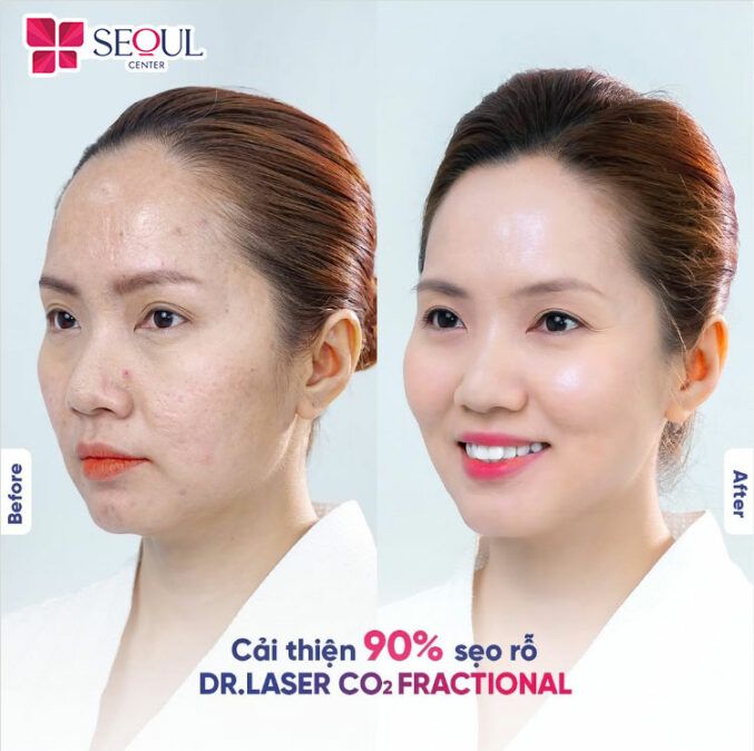 Tái Tạo Rỗ Mô Da COFar P2P