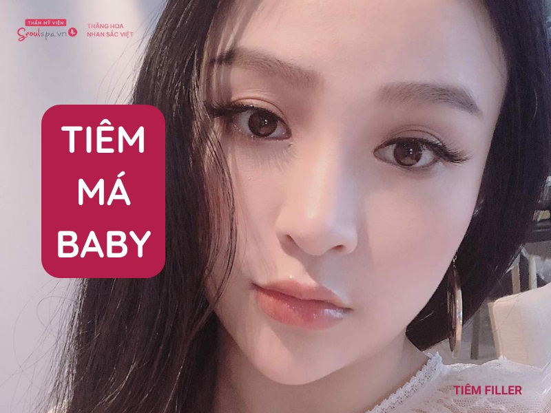 Tiêm má baby là gì? Tiêm má bao nhiêu cc là đẹp?