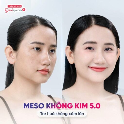 Cấy meso extra không kim giá bao nhiêu tiền? Giá mới 7/2025
