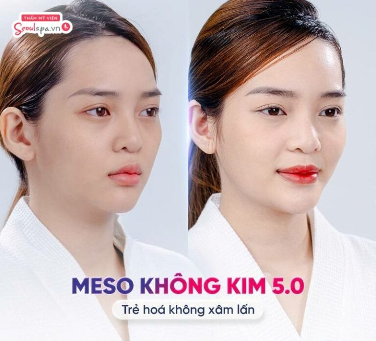 Cấy meso extra không kim giá bao nhiêu tiền? Giá mới 7/2025
