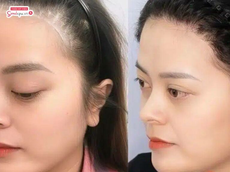 Triệt tóc trán là gì? Triệt đường chân tóc có giá bao nhiêu tiền?