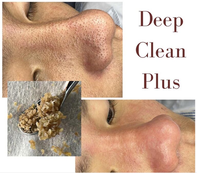 Top 7 địa chỉ spa trị mụn Long Khánh Đồng Nai uy tín bạn nên biết